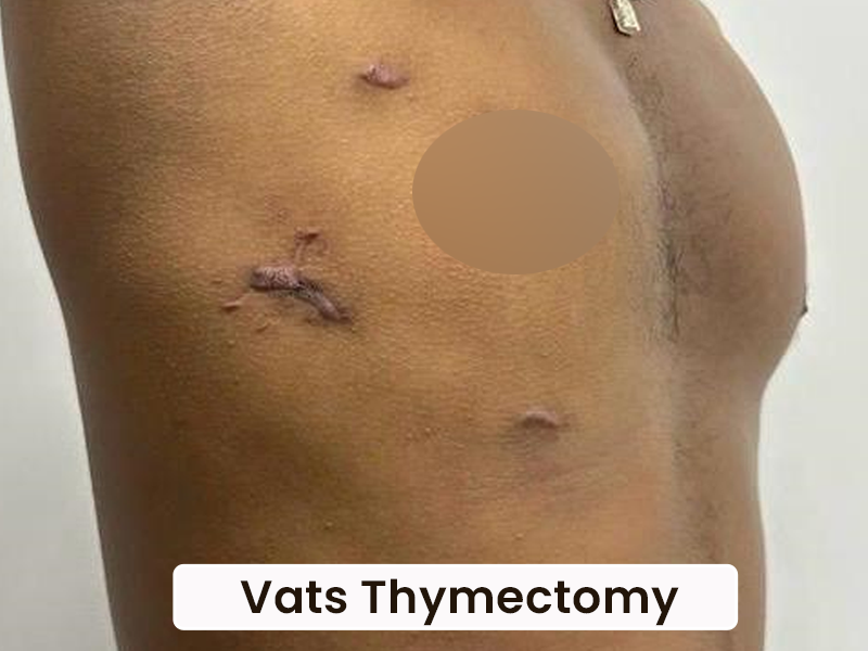 Explore Thoracic Surgery Highlights | Dr. Balasubramoniam KR